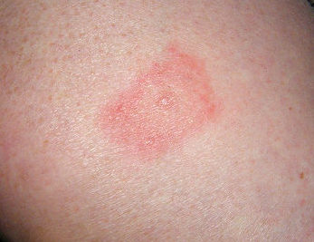 Mückenstichallergie: Symptome mit Bildern und Tipps für Allergiker