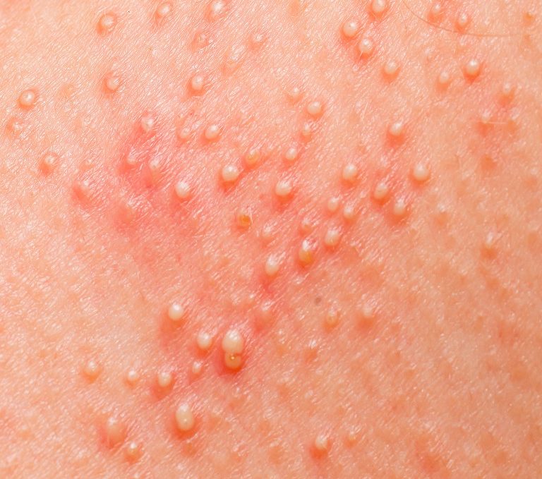 Hitzepickel Oder Allergie Was Ist Der Unterschied Hitzepickel Oder Allergie Was Ist Der Unterschied